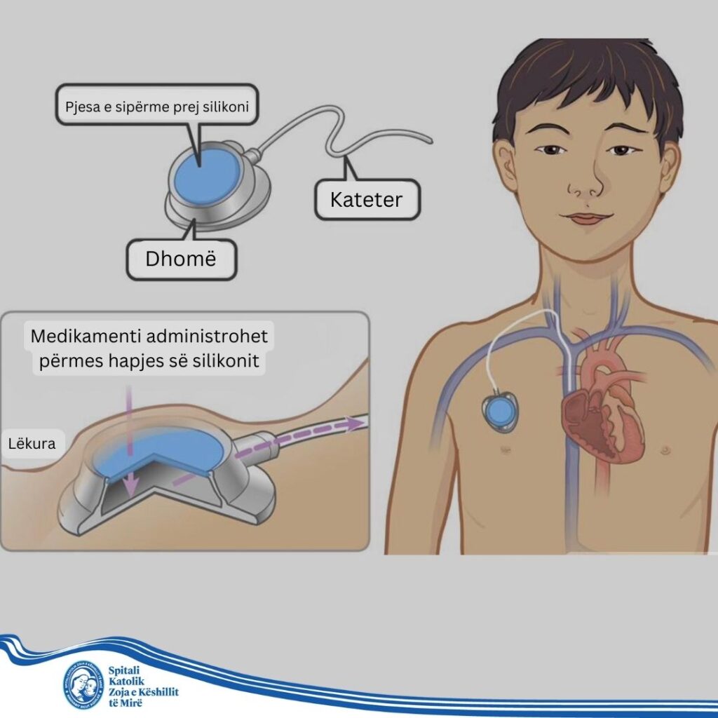 PROCEDURA MINI INVASIVE - PORT A CATH KATETER