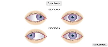 Strabizmi - Spitali Katolik Zoja e Këshillit të Mirë